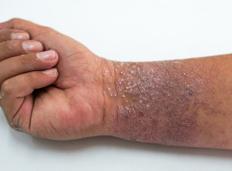 Understand Atopic Dermatitis: What You Need to Know – Caresupp.in